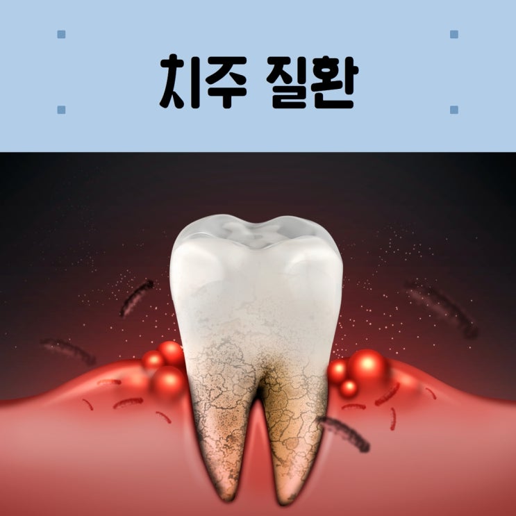 치주 질환 증상 원인 치료 예방 네이버 블로그