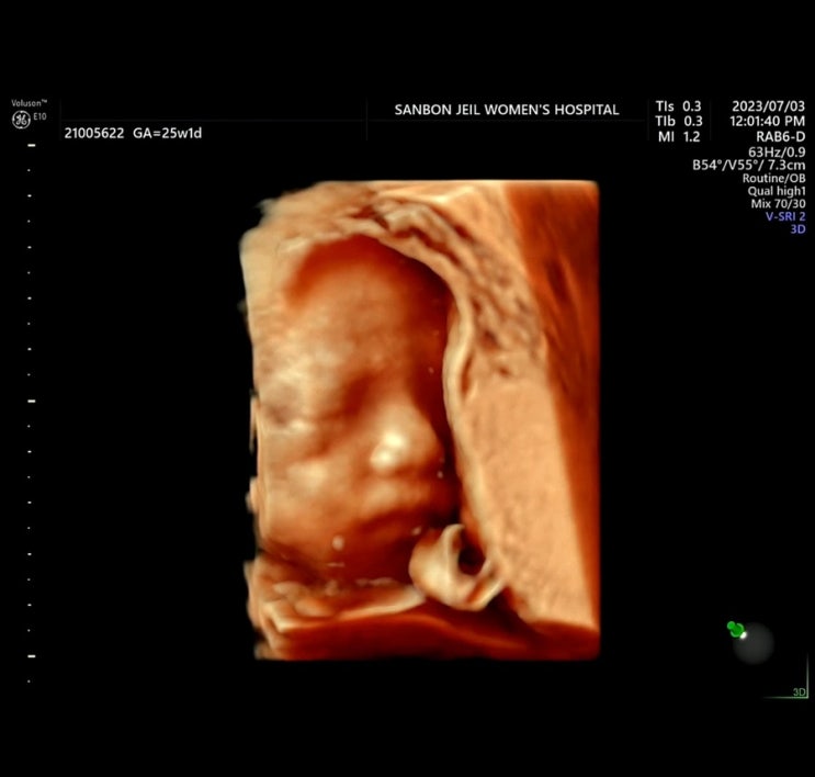 [임신 25주차] 산본제일병원 임당검사, 입체초음파, 아기용품선물, 신체변화 : 네이버 블로그