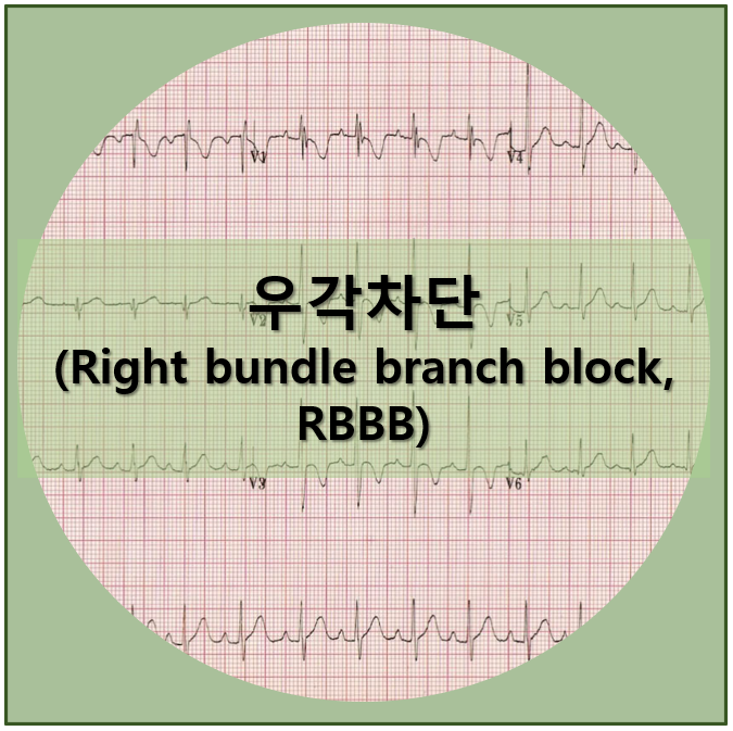 우각차단 (Right bundle branch block, RBBB) 정의, 심전도(EKG), 원인과 예후 정리 : 네이버 블로그