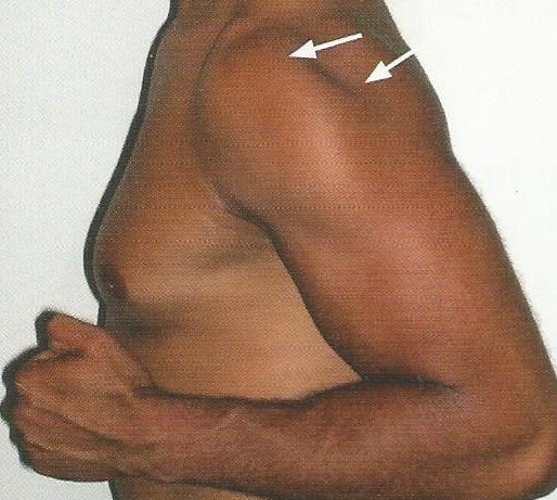 잠실PT) 석촌PT) "상완골 전방활주 증후군(Humeral Anterior Glide Syndrome)" 알아보겠습니다 ...