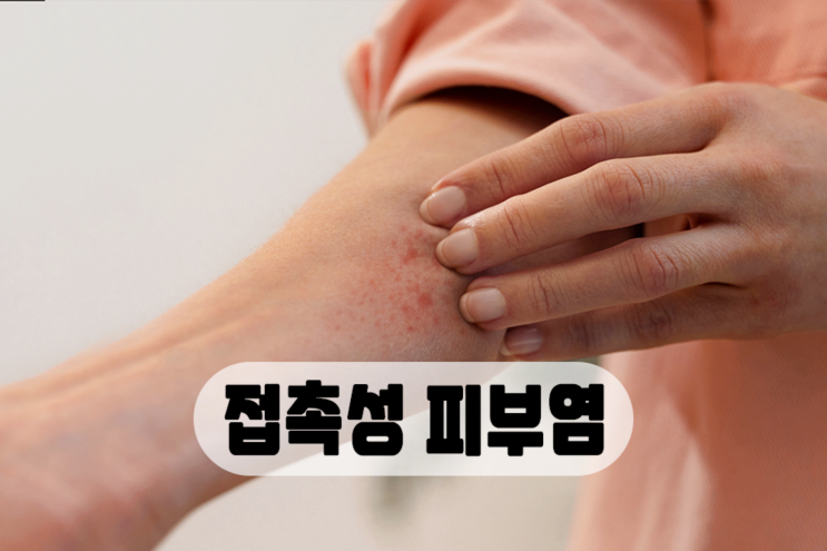 쇳독 다리 얼굴 목 접촉성 피부염 증상 원인 네이버 블로그