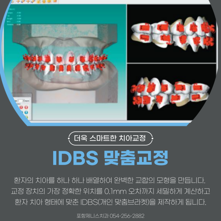 IDBS 개인 맞춤 교정,제니스치과 : 네이버 블로그