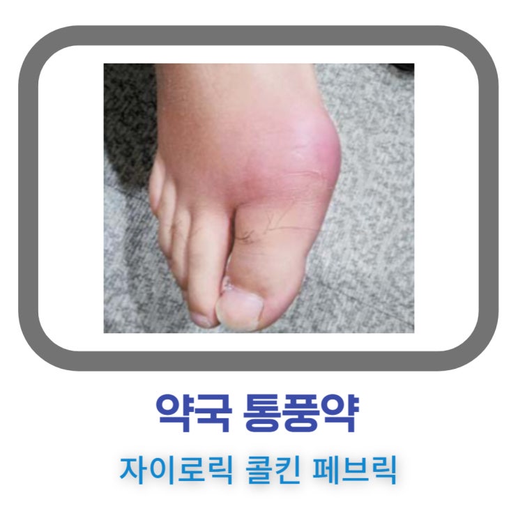 약국 통풍약 콜키신콜킨정 페북소스타트페브릭정 알로푸리놀자이로릭 효능 효과 부작용 성분 분석 네이버 블로그