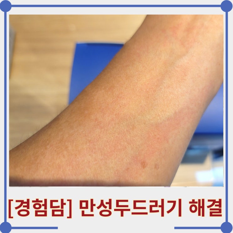 [경험담] 피부 긁으면 만성두드러기 치료도 좋지만 관리가 매우 중요 : 네이버 블로그