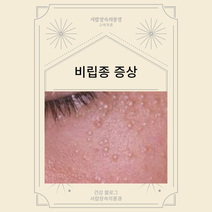 비립종 증상 눈 비립종 비립종 제거 비립종 원인 눈밑 비립종 네이버 블로그