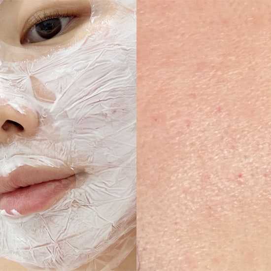 내돈내산 피부과 스킨부스터 쥬베룩 하이쿡스 시술 Vs 볼륨 가격비용 한 달 효과 주의사항 후기 네이버 블로그