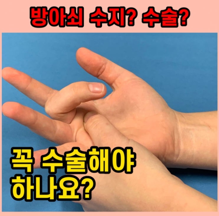 방아쇠수지수술 방아쇠수지 증후군 어디서 수술 네이버 블로그
