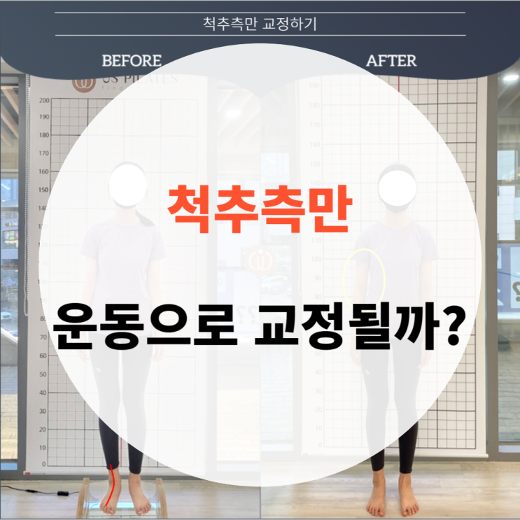 청소년 척추측만증 알아보자 네이버 블로그