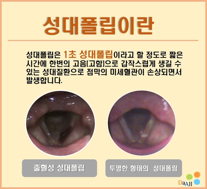 성대폴립 성대폴립 치료 궁금증 해결 성대폴립은 무엇인가 수술해야만 할까 안하면 어떻게 될까 산본 다올한의원