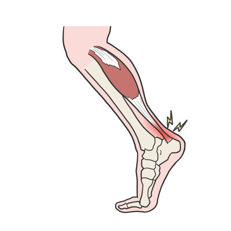 발목뒷쪽 통증 발꿈치 통증 아킬레스건염 원인 증상 치료 한의원 네이버 블로그