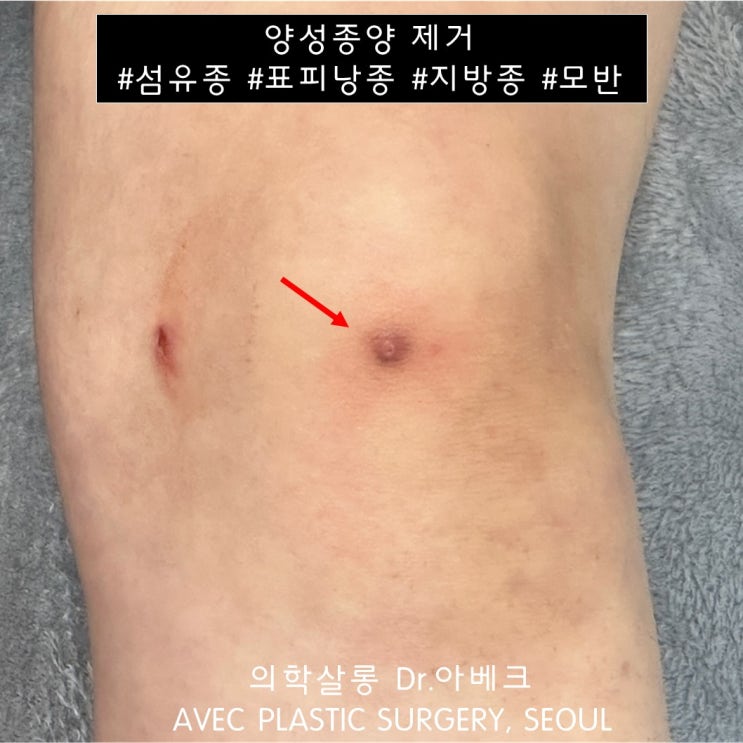 표피낭종피지낭종 제거 후기 무릎 낭종 【dr 아베크 양성종양】 네이버 블로그