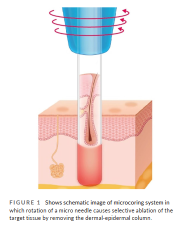 모공 흉터 치료 : microcoring : 네이버 블로그