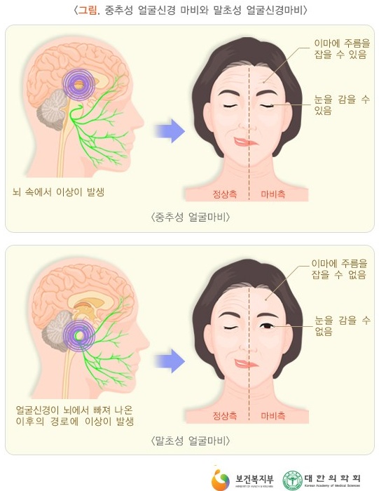 구안 와사안면 신경마비와 스테로이드 부작용 제주 온기담은 한의원 네이버 블로그