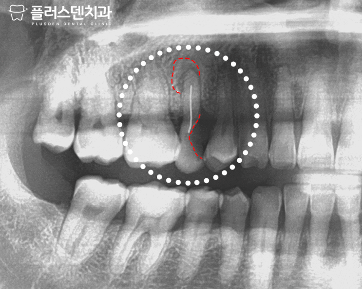훈련소에서 제때 치료 받지 못했던 20대 군인 임플란트 전농동 플러스덴 치과 에서 뼈이식 동반해 짧은 기간 으로 어금니 수술