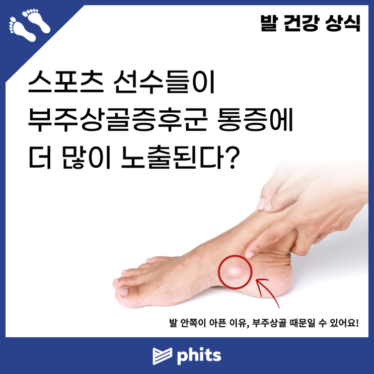 발 건강 상식부상 스포츠 선수들이 부주상골증후군 통증에 더 많이 노출된다 부주상골 통증으로 병원에 내원하는 스포츠 종목