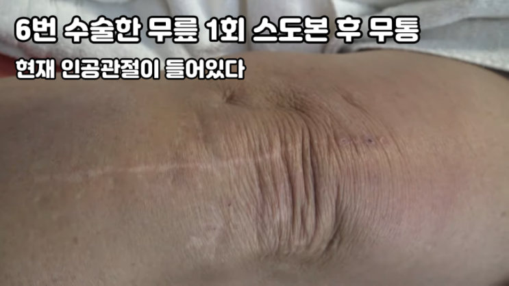 425. 무릎 수술 6회, 인공관절 삽입한 사람 KSNS KSS 스본 스도 1회로 통증 사라지다 : 네이버 블로그