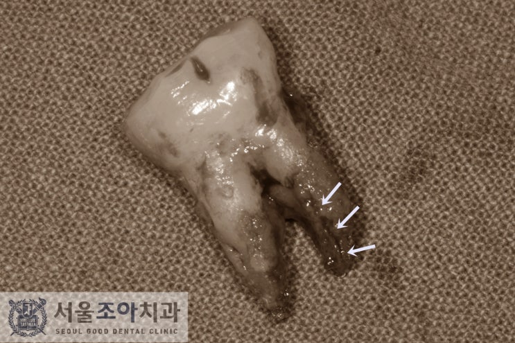 뿌리에 금간 치아의 임플란트 증례 걸포동 임플란트 네이버 블로그