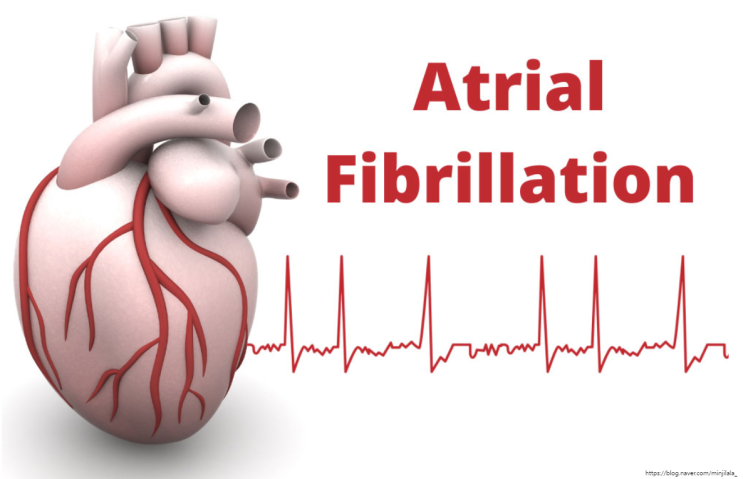 심방세동 atrial fibrillation AF Afib 원인 종류 검사 증상 심전도 특징 치료 (anticoagulation ...