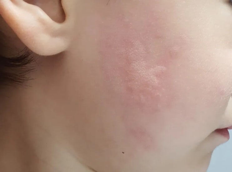 36개월 아기 두드러기 낮잠 자다 식겁 수시로 올라왔다 내려갔다 콜린성 두드러기 원인 네이버 블로그