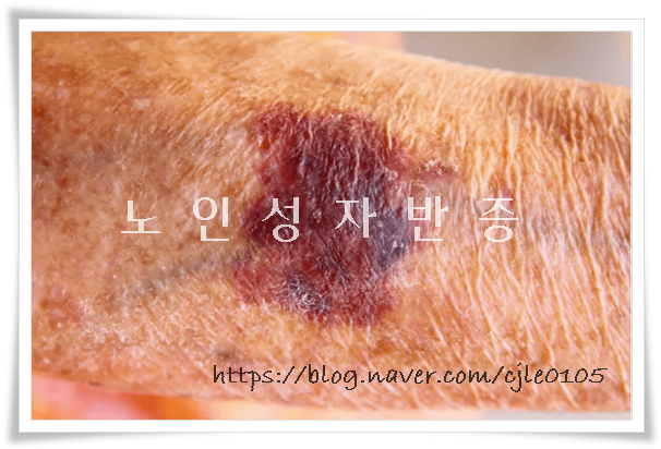 자반증한의원 피부빨간점 피부붉은반점 자반증은 왜 생길까 노인성자반증 피멍 점상출혈 네이버 블로그