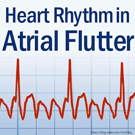 심방조동 atrial flutter AFL 심전도 증상 치료 (+ 심방세동 atrial fibrillation AF 차이점 ...