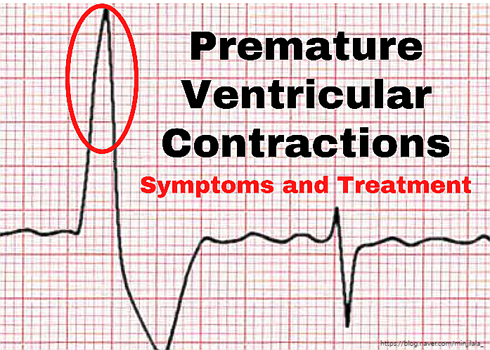 심실조기수축 심실조기박동 PVC VPC premature ventricular complex 심전도 증상 종류 원인 시술 치료 ...