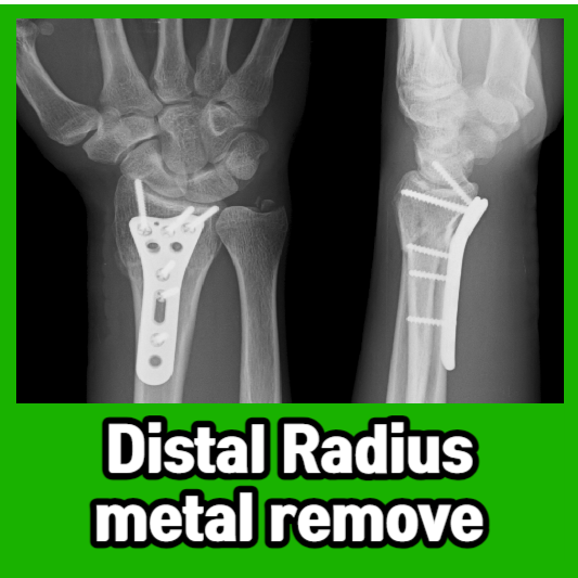 Distal Radius metal remove HWR 수술 : 네이버 블로그