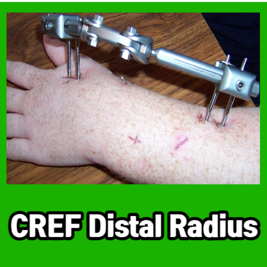 CREF distal Radius Fracture 수술 (폐쇄성정복외부고정술) : 네이버 블로그