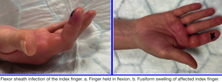[수부] 손의 감염 (deep) : thenar, hypothenar, midpalmar space infection : 네이버 블로그