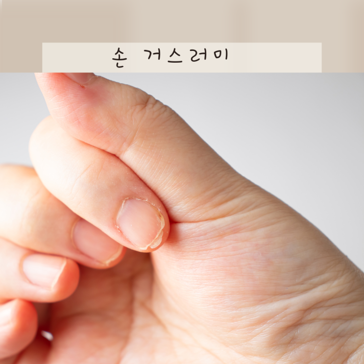 손톱 옆 고름 염증 통증 손 거스러미 조갑주위염 생손앓이 생인손 치료 손톱주위염 이렇게 하자 네이버 블로그