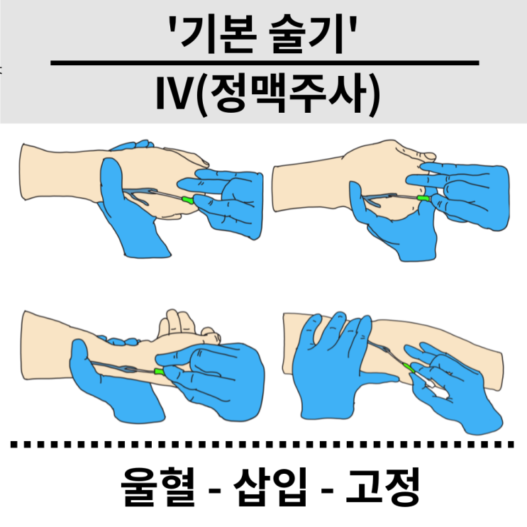IV(Intravenous) line, 정맥주사 고수되기 : IV 기본 Technique : 네이버 블로그