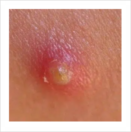 절종, 옹종(Furuncle, Carbuncle)이란? : 네이버 블로그