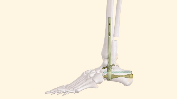 [OS수술] Ankle TTC(Tibiotalocalcaneal) Fusion(발목관절유합술) : 네이버 블로그