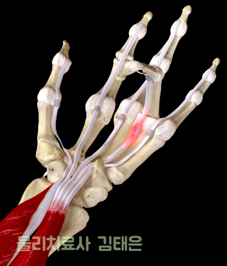 방아쇠수지증후군trigger Finger 손가락 딸깍 소리 원인 및 치료 방법 네이버 블로그