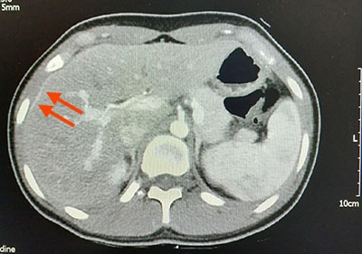 Fitz-Hugh-Curtis 증후군 : 네이버 블로그