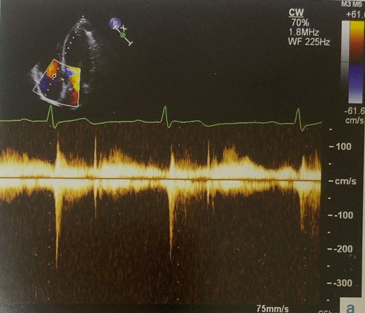 Tricuspid valve의 spectral doppler - "TRVmax 그리고 TR maxPG" : 네이버 블로그