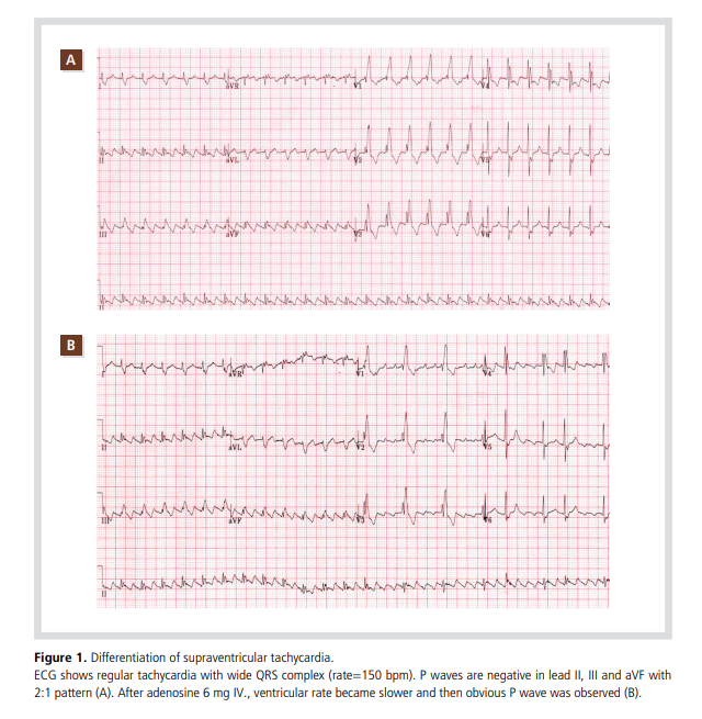 실상성 빈맥(supraventricular tachycardia, SVT)이란? : 네이버 블로그