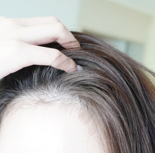 두피스케일링 헤어토닉 두피쿨링스프레이 다슈 네이버 블로그