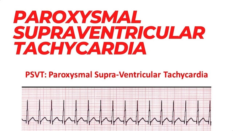 발작성상심실성빈맥 PSVT paroxysmal supraventricular tachycardia 특징 증상 심전도 치료 ...
