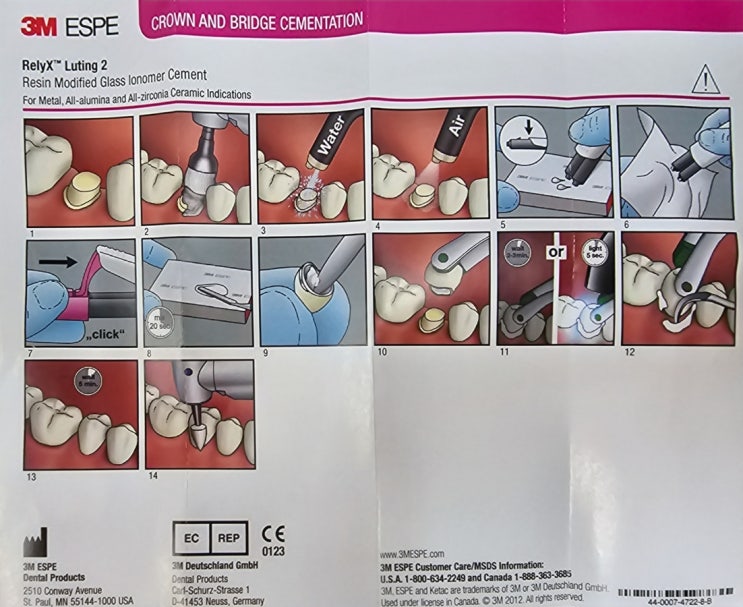 [ITEM] RelyX Luting 2 cement (쓰리엠 RMGI 시멘트) : 네이버 블로그