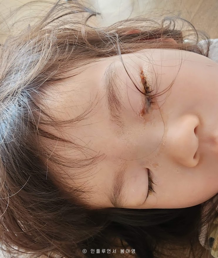 요즘 유행하는 감기 증상 아데노바이러스 눈꼽감기 등원 전염 네이버 블로그
