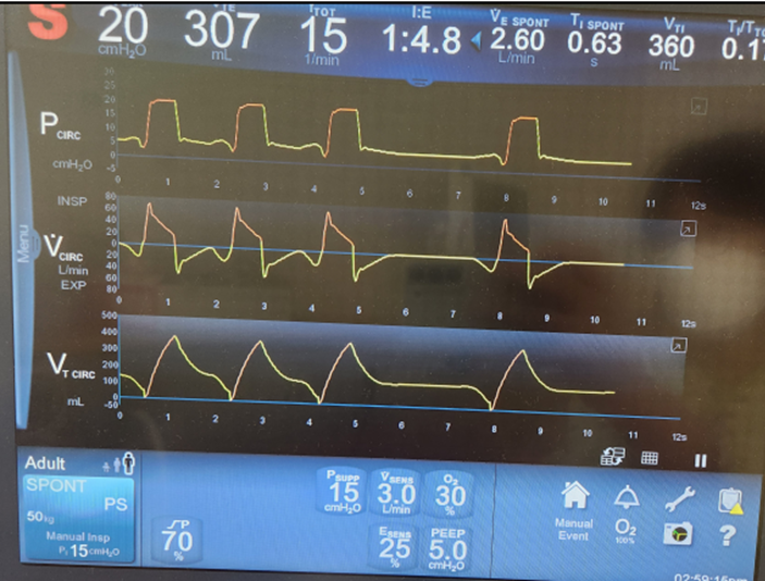 인공환기 모드 Pressure support mode, PS, PSV, CPAP 모드에 대해서 : 네이버 블로그