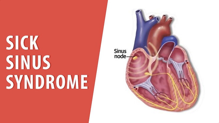 동기능부전증후군 SSS sick sinus syndrome SA block SA arrest 정의 심전도 검사 치료 ...