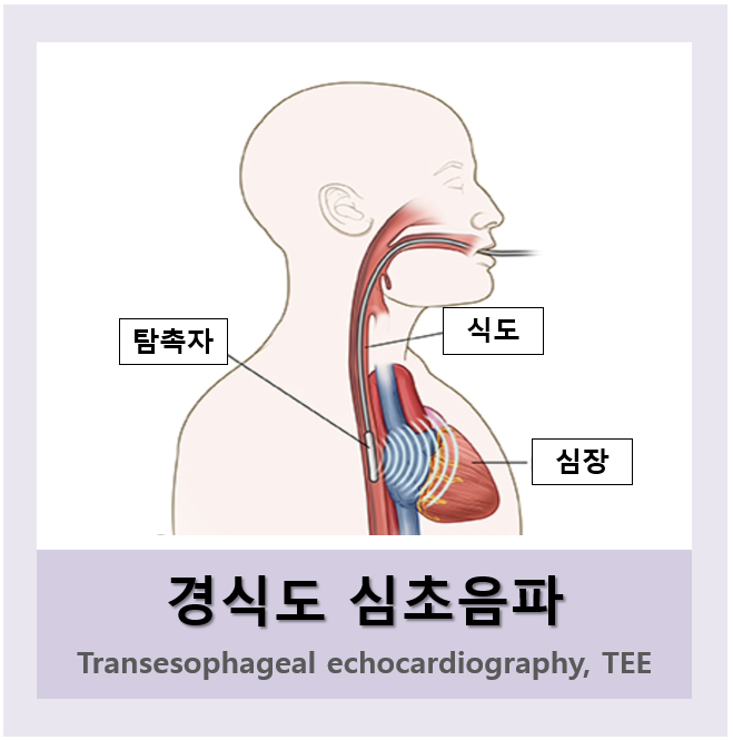Tee 의학용어 경식도심초음파 검사 목적 적응증 전후 준비사항 Transesophageal 네이버 블로그