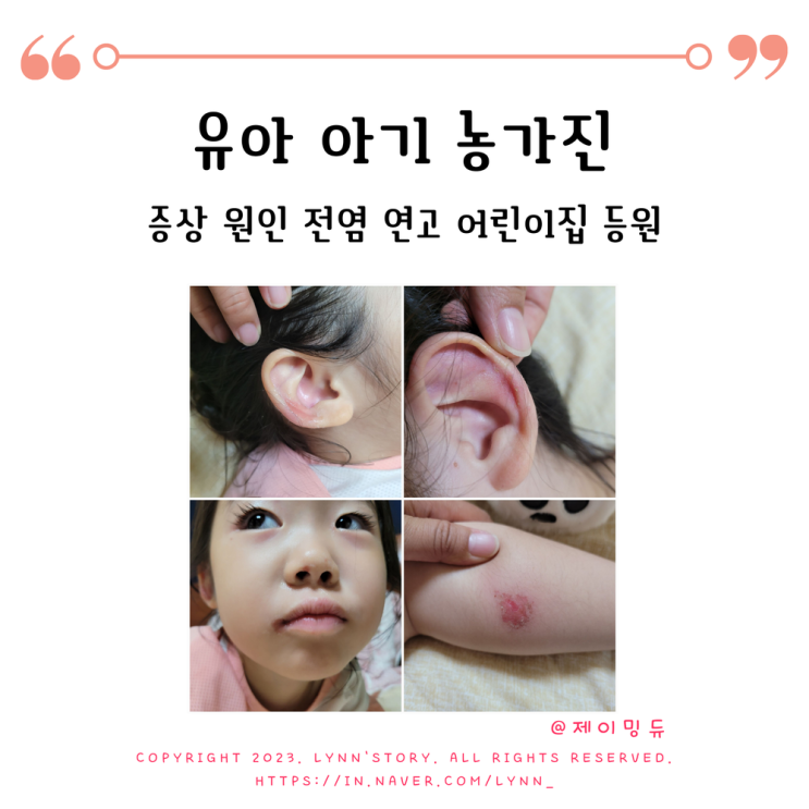 유아 아기 농가진 원인 증상 전염 연고 어린이집 등원 언제부터 네이버 블로그