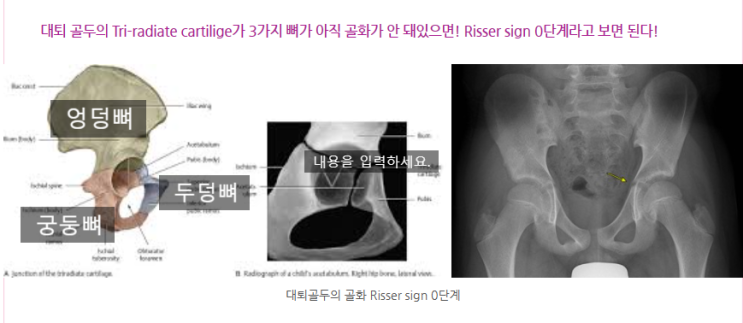 골반의구조 (with 뉴만 엉덩관절 2편) : 네이버 블로그