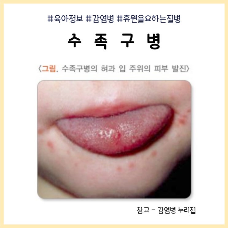 4급 법정감염병 수족구 증상 전염 어린이집 등원여부 네이버 블로그