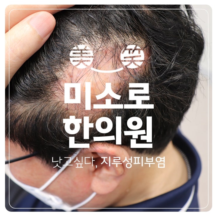 대전지루성피부염치료 병원 한방요법으로 소양감을 바로잡아 네이버 블로그