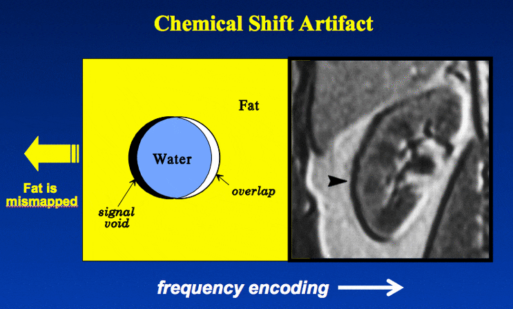 Chemical Shift Artifact : 네이버 블로그