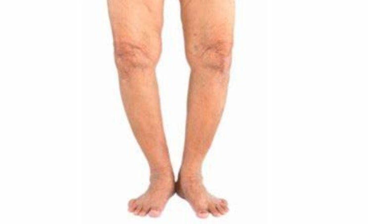안굽이 무릎(Genu Varum, Bandy Legs, Bow legs)의 특징 : 네이버 블로그